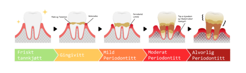 Periodontitt: Alt du trenger å vite | Kløfta Tannhelsesenter ...